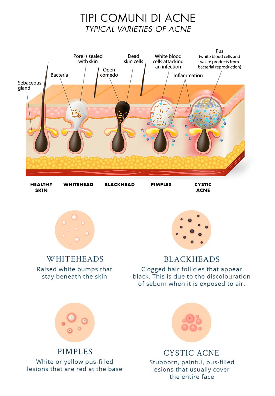 The OLEO Series: Your Ultimate Acne-Fighting Solution - Impress Esteem